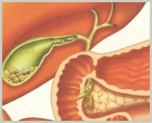 Cálculos Biliares: Síntomas Y Causas